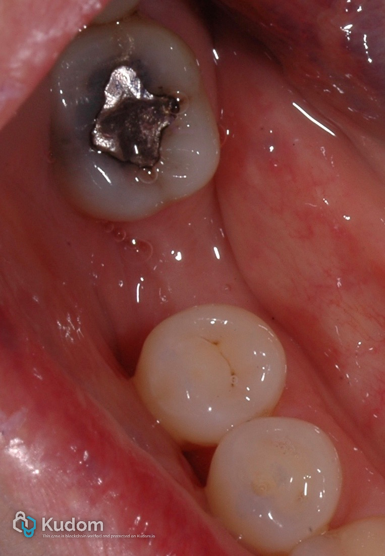 Kudom | Direct pulp capping in an adult