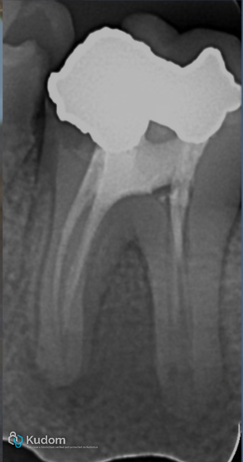 Kudom | Management of Apical Root Resorption Associated with Failed ...