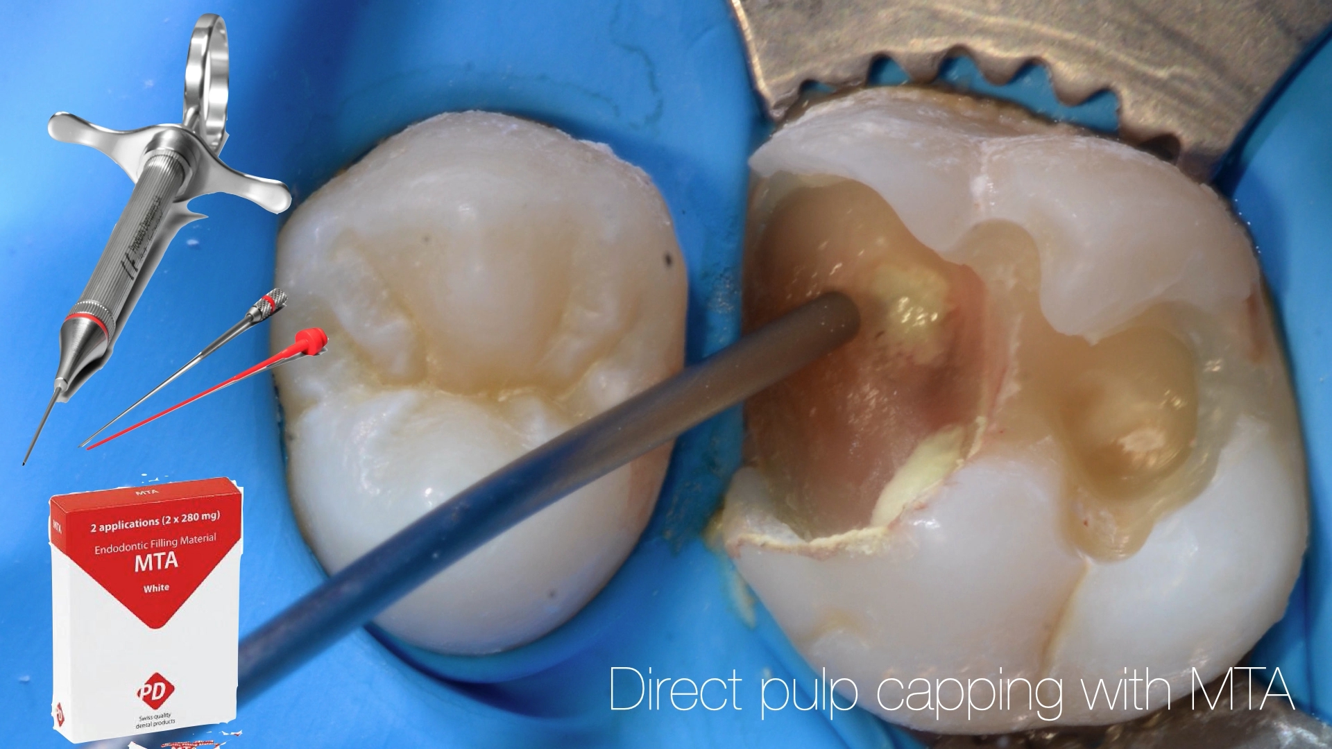 Kudom | Direct Pulp Capping