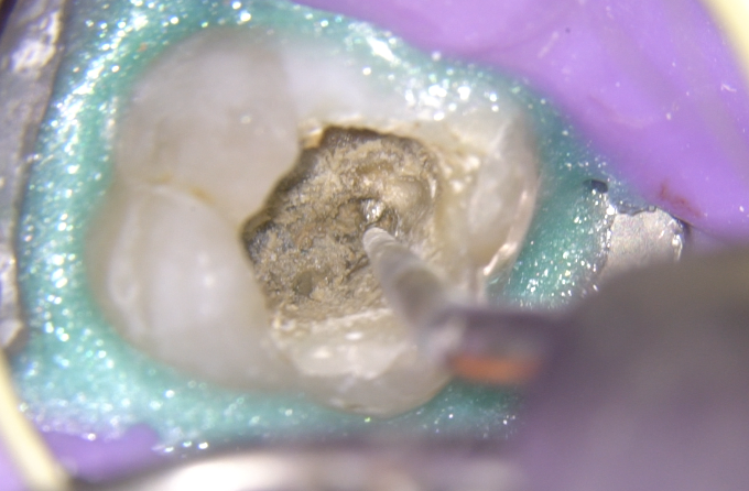 Kudom | Silver cones still present. Retreatment of an upper molar.