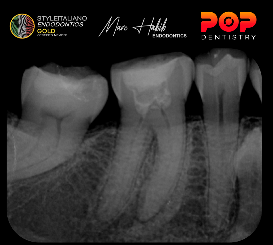 Kudom | Conservative Shaping in long roots with narrow root canals