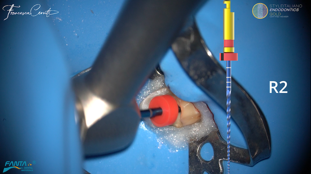 Kudom | Endodontic treatment of a lower 5 with Rising